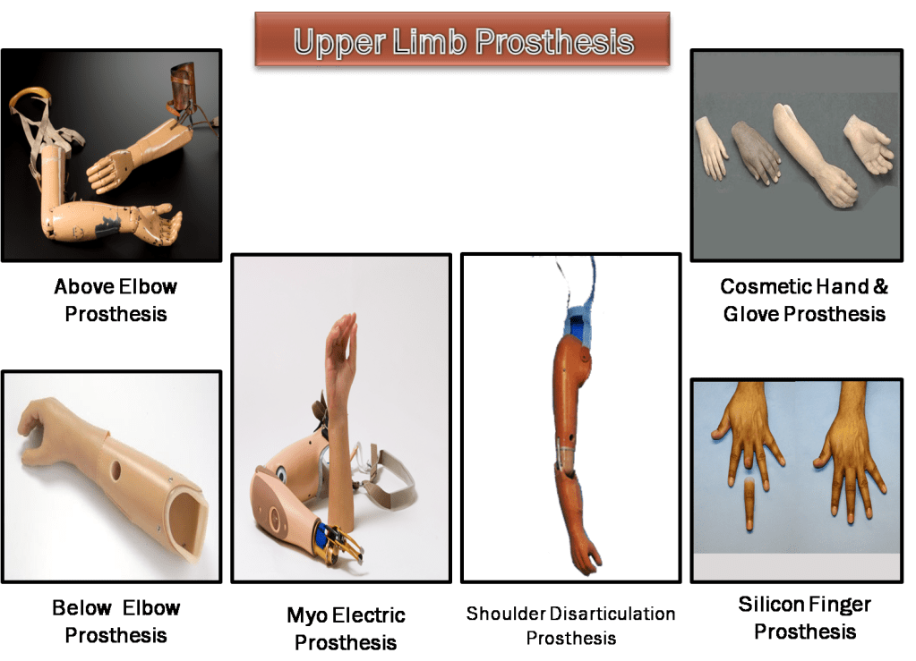 Upper Extremity Prosthesis – Creative Orthotic and Prosthetic Solutions